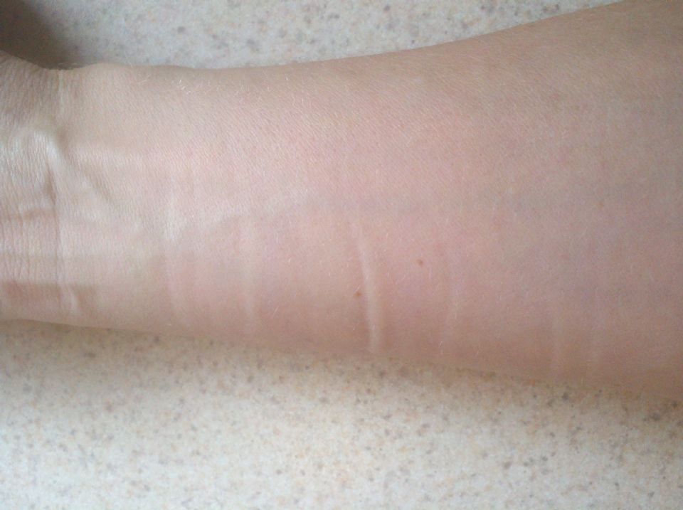 Raised White Lines Across Inside Of Wrist Hoping Someone Knows What raised-white-lines-across-inside-of-wrist-hoping-someone-knows-what